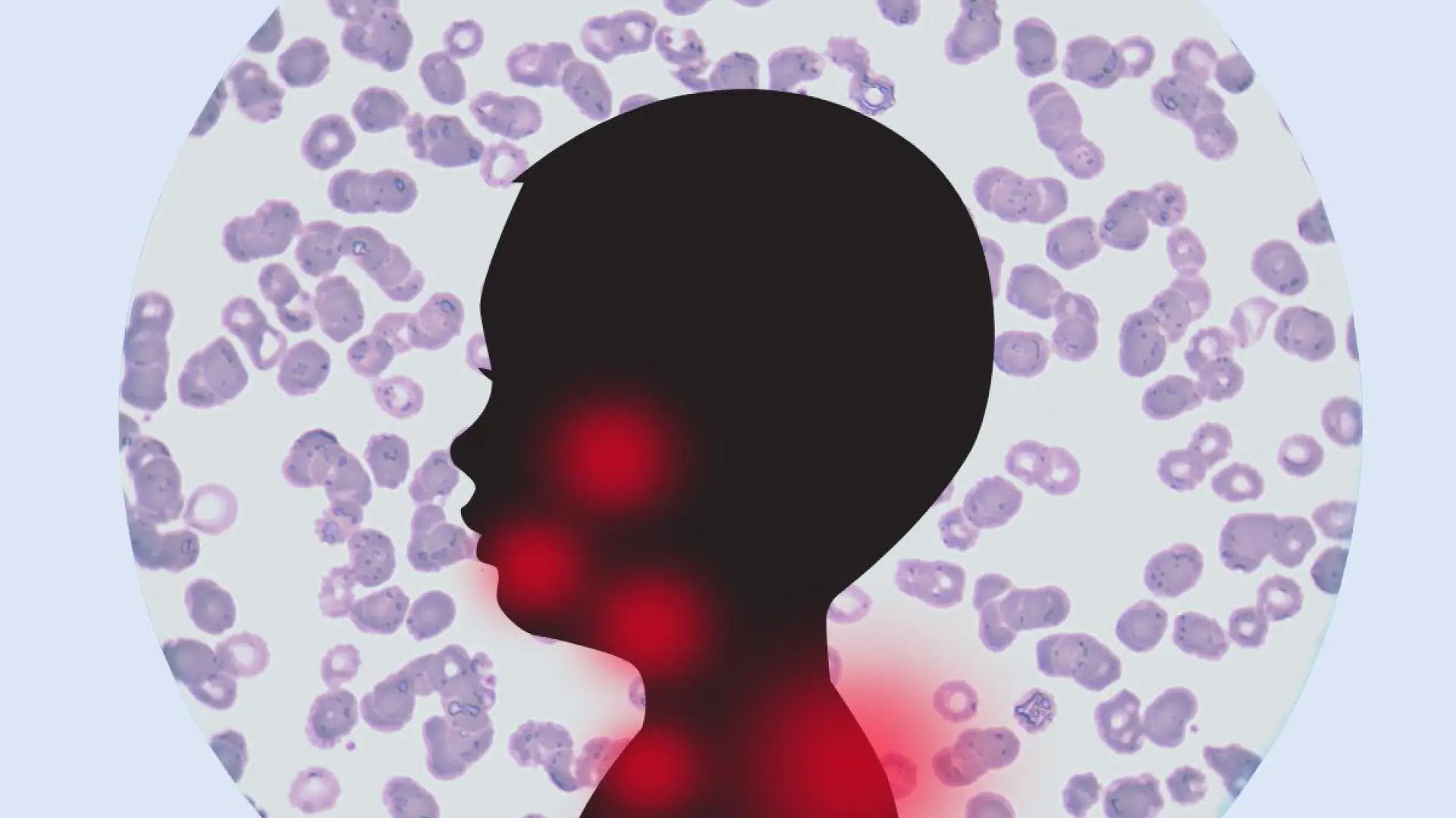 Escarlatina: causas, síntomas, tratamiento y su relación con el ...