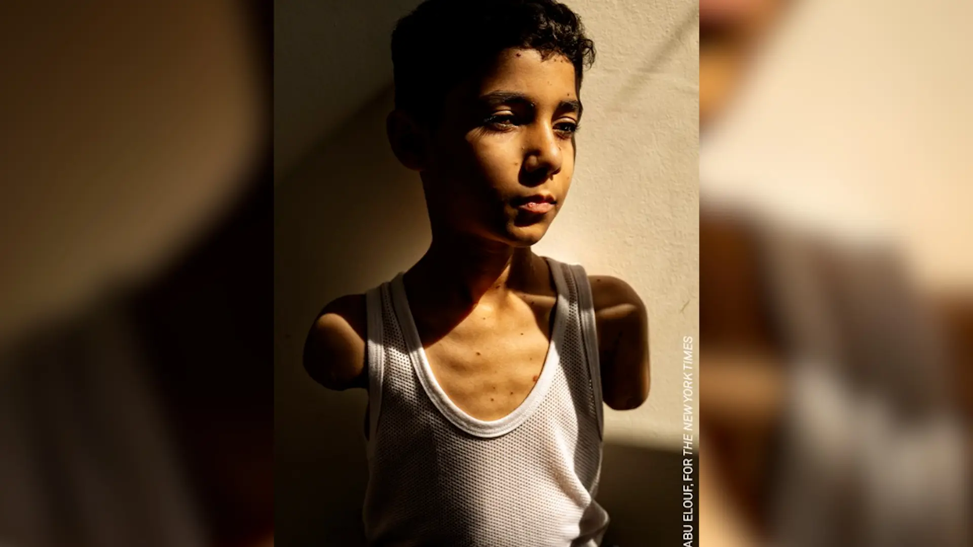 La imagen de un niño mutilado en un ataque en Gaza, foto del año del ...