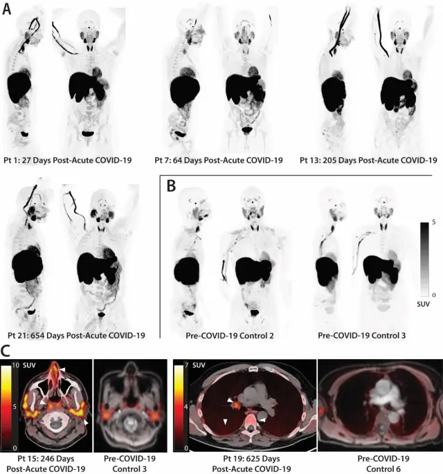 Los pacientes con covid persistente conservan ARN viral y células T ...