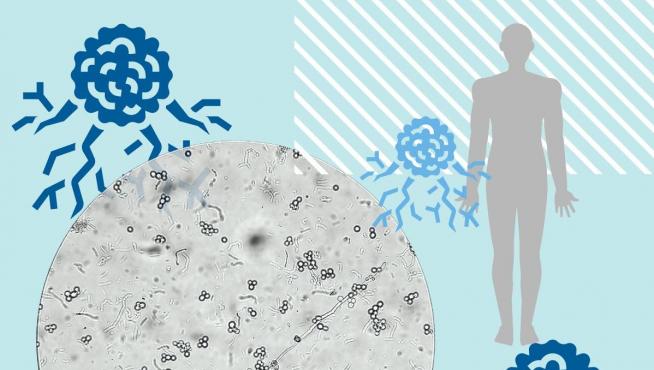 Qué es la Candida parapsilosis, síntomas y el tratamiento del hongo que ...