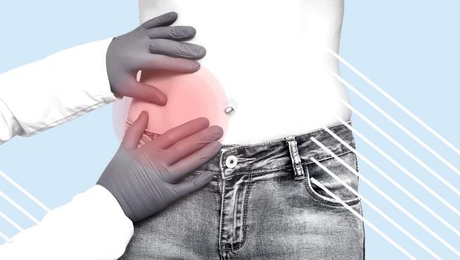 Qué es la peritonitis: síntomas, cómo detectarla y tratamiento
