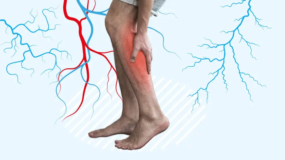 Varices, un mal que nos atormenta y "una causa importante de pérdida de ...