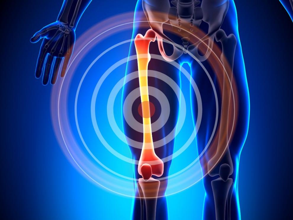Sarcoma de Ewing: síntomas, causas y esperanza de vida