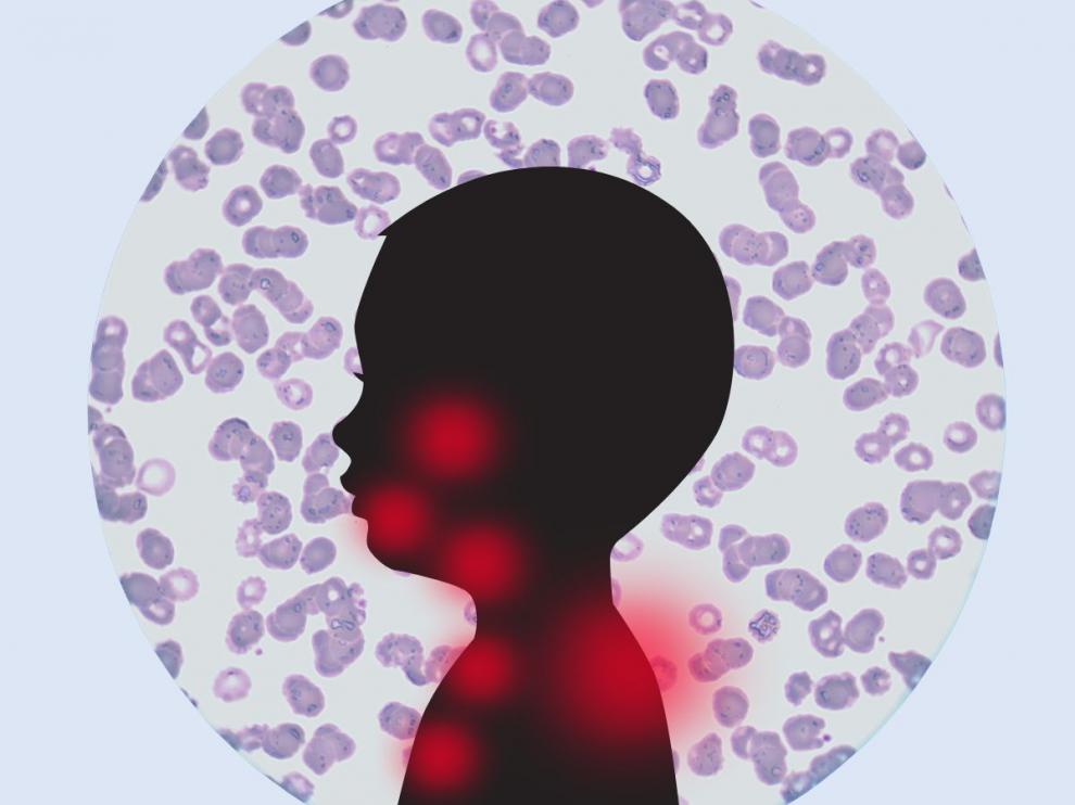 Escarlatina: causas, síntomas, tratamiento y su relación con el ...