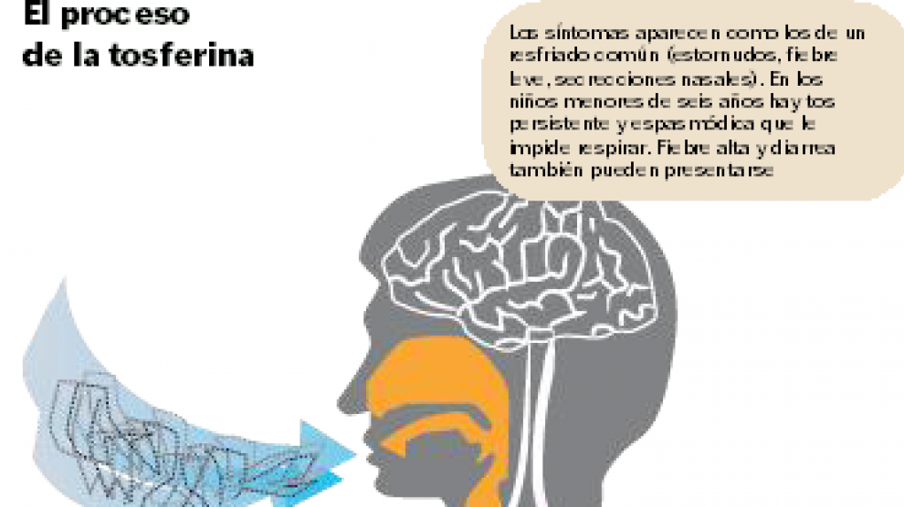 Aragón registra un brote de tosferina con tres hermanos afectados