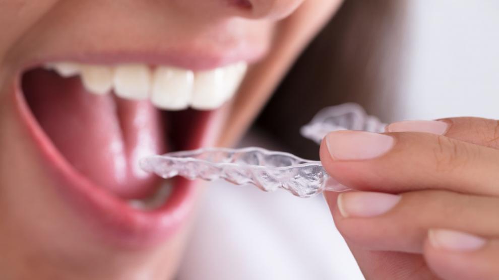 Los dentistas exigen prohibir la venta directa de férulas para tratar ...