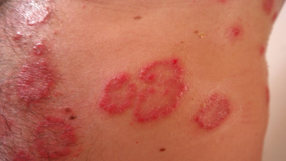 Día Mundial de la Psoriasis: una enfermedad que va más allá de una ...