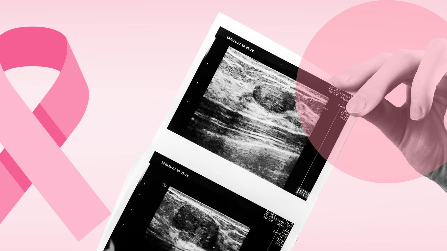 Así se manifiesta el cáncer de mama: estos son los primeros síntomas a ...